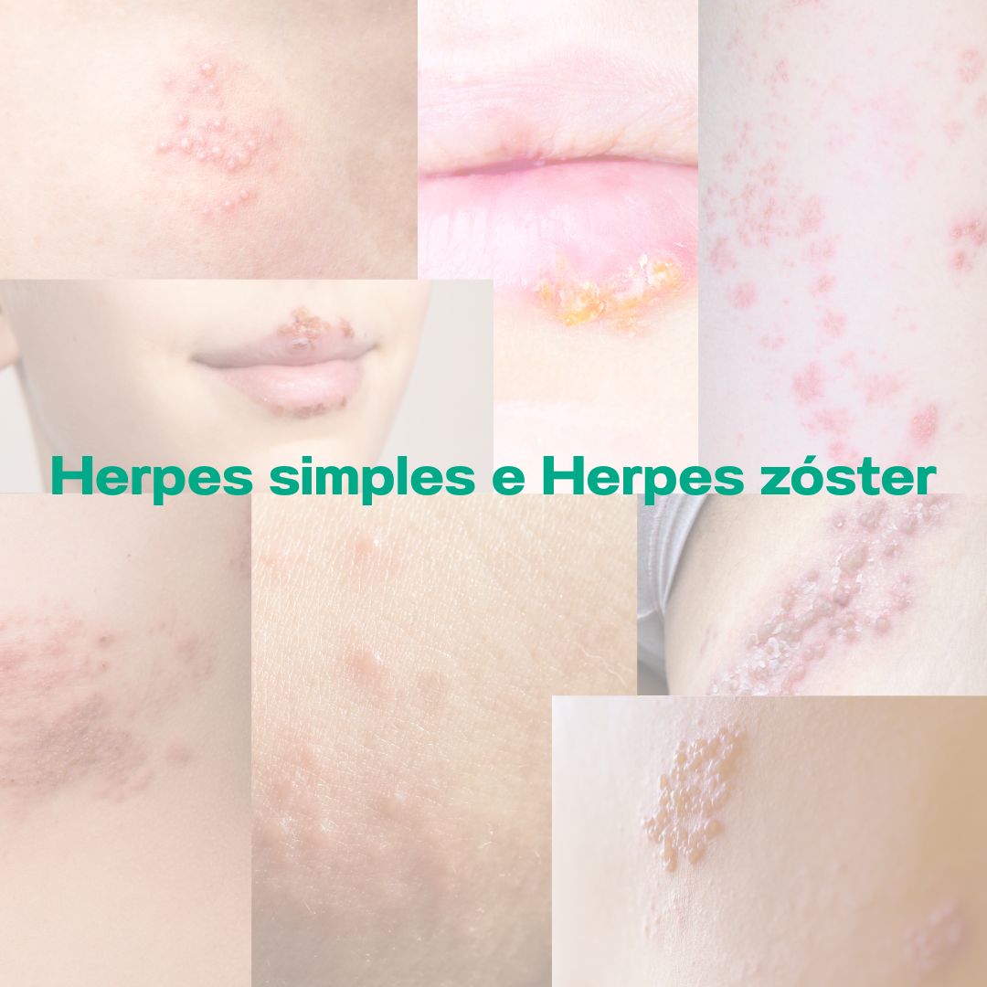 Rosto De Herpes Simples